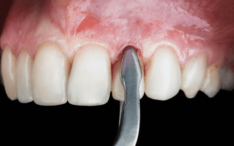 Complete Guide to Healing After Tooth Extraction